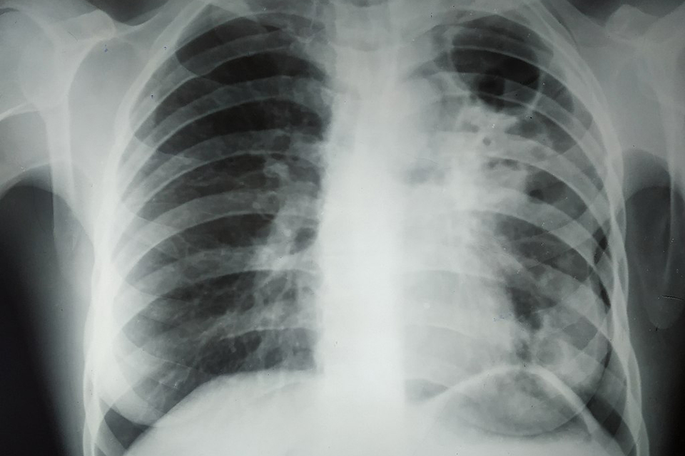 tuberkuliozė - Atvira Klaipėda